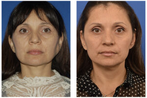 Photo Gallery | Center for Advanced Parotid Surgery in Beverly Hills, CA