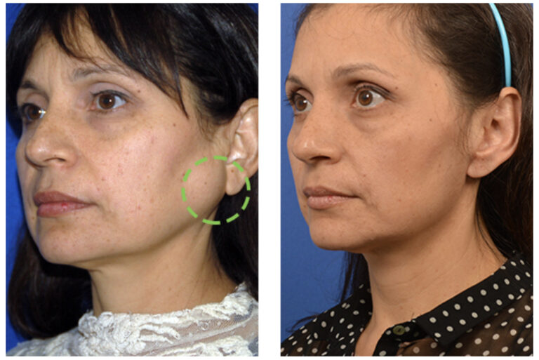 Photo Gallery | Center for Advanced Parotid Surgery in Beverly Hills, CA