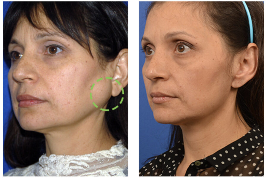 Photo Gallery | Center for Advanced Parotid Surgery in Beverly Hills, CA