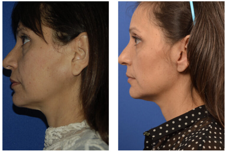 Photo Gallery | Center for Advanced Parotid Surgery in Beverly Hills, CA