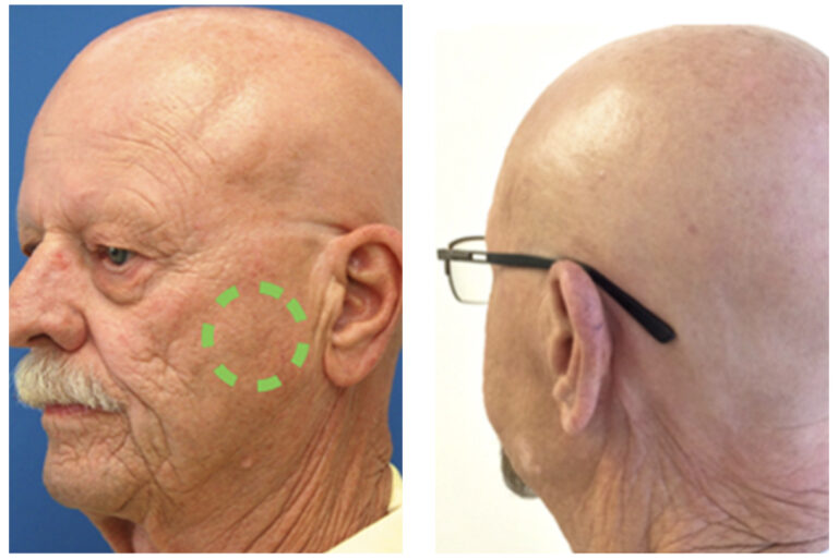 Photo Gallery | Center for Advanced Parotid Surgery in Beverly Hills, CA