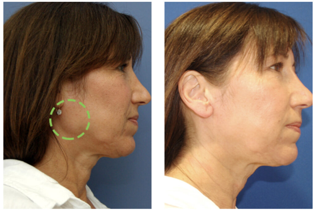 Photo Gallery | Center for Advanced Parotid Surgery in Beverly Hills, CA