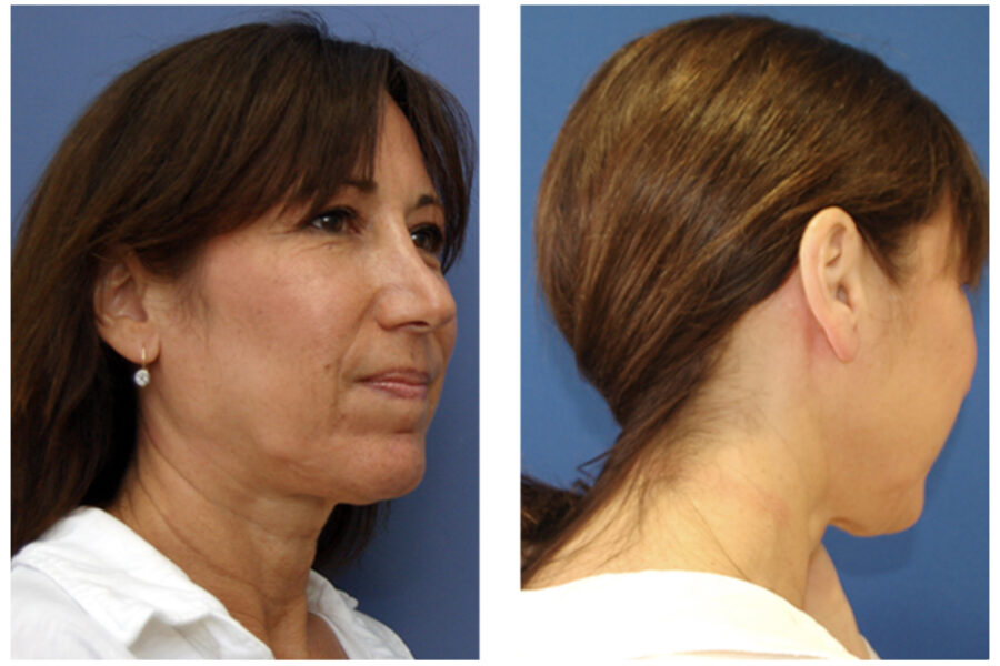 Photo Gallery | Center for Advanced Parotid Surgery in Beverly Hills, CA