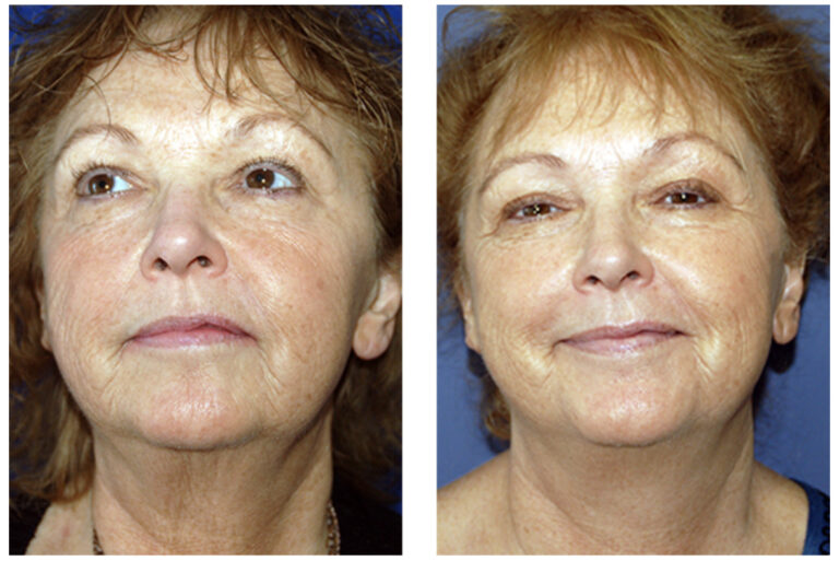 Photo Gallery | Center for Advanced Parotid Surgery in Beverly Hills, CA