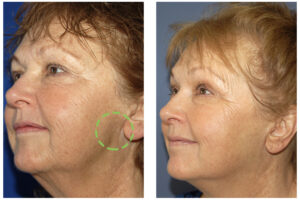 Photo Gallery | Center for Advanced Parotid Surgery in Beverly Hills, CA
