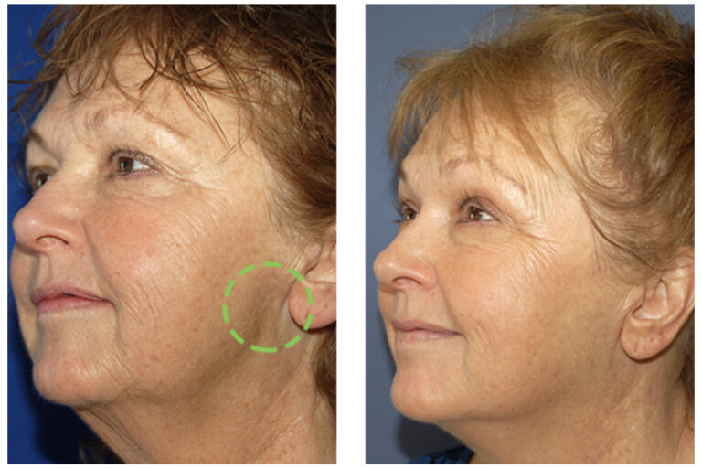 Photo Gallery | Center for Advanced Parotid Surgery in Beverly Hills, CA
