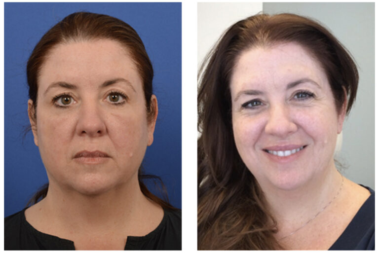 Photo Gallery | Center for Advanced Parotid Surgery in Beverly Hills, CA
