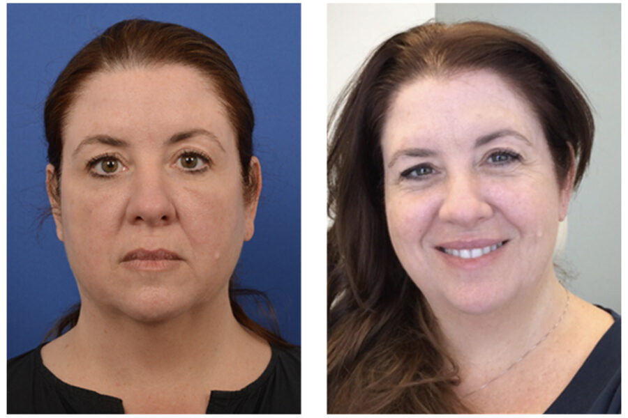 Photo Gallery | Center for Advanced Parotid Surgery in Beverly Hills, CA
