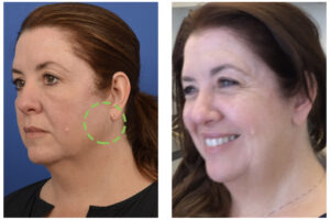 Photo Gallery | Center for Advanced Parotid Surgery in Beverly Hills, CA