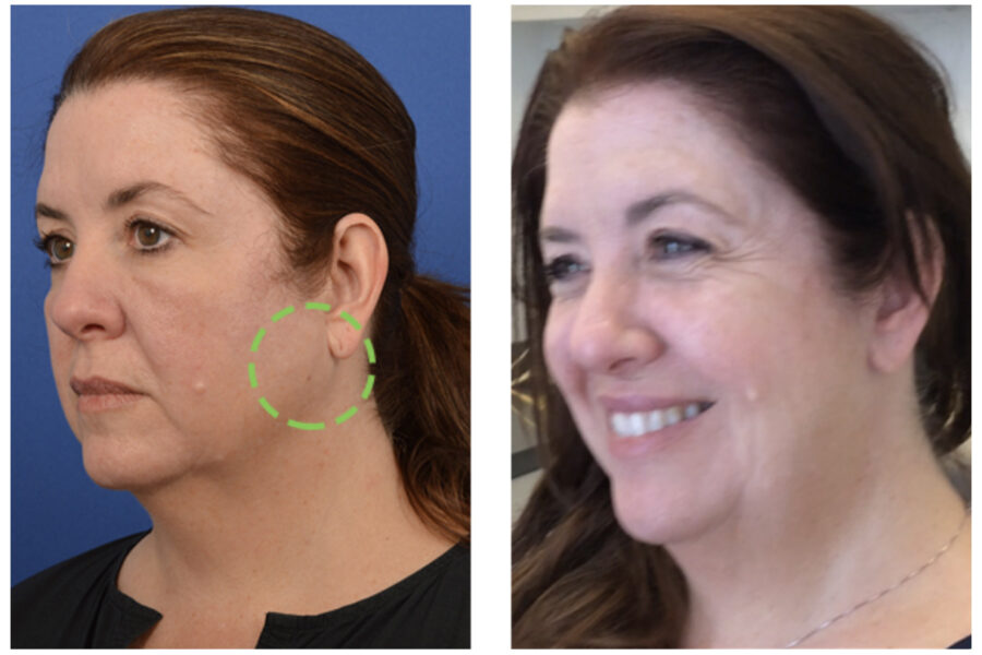 Photo Gallery | Center for Advanced Parotid Surgery in Beverly Hills, CA
