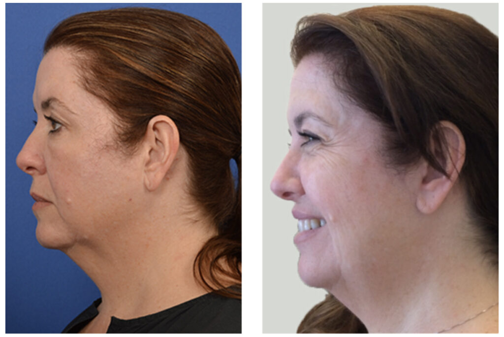 Photo Gallery | Center for Advanced Parotid Surgery in Beverly Hills, CA