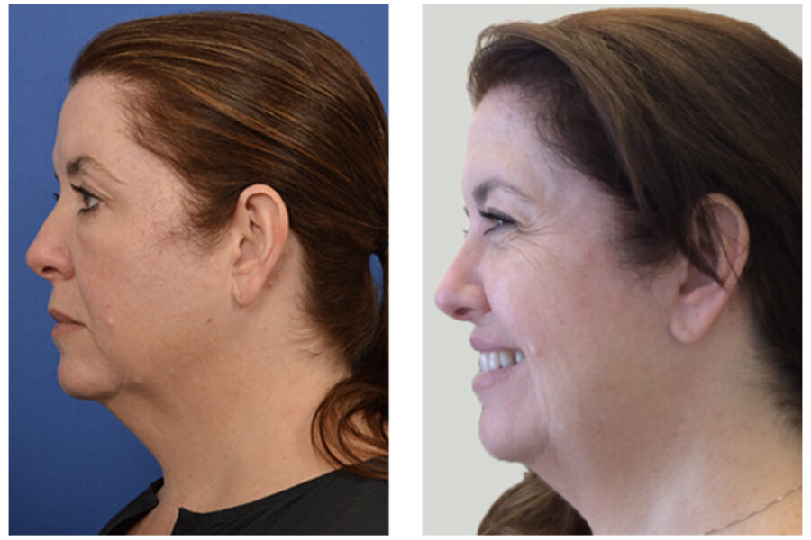 Photo Gallery | Center for Advanced Parotid Surgery in Beverly Hills, CA