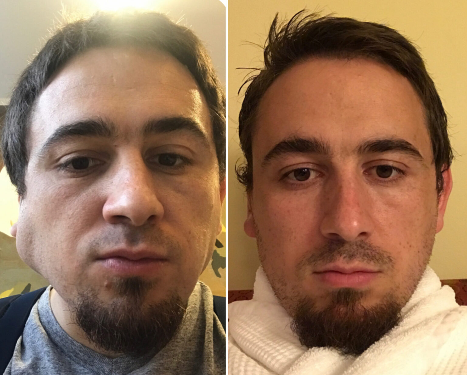 Mucocele and Ranula | Center for Advanced Parotid Surgery in Beverly ...