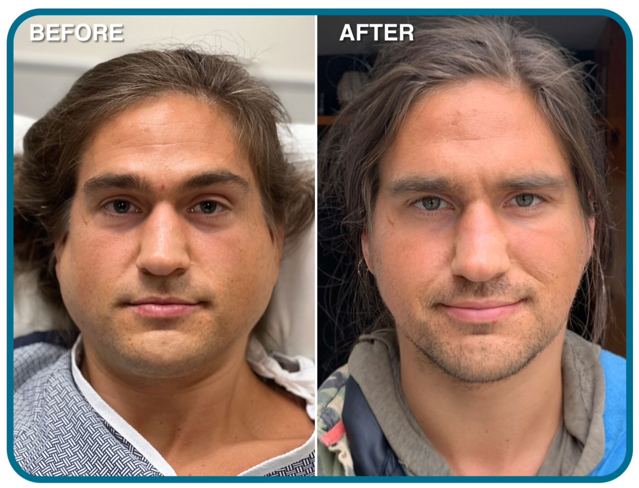 Bilateral Parotidectomy in Beverly Hills, CA | Center for Advanced ...