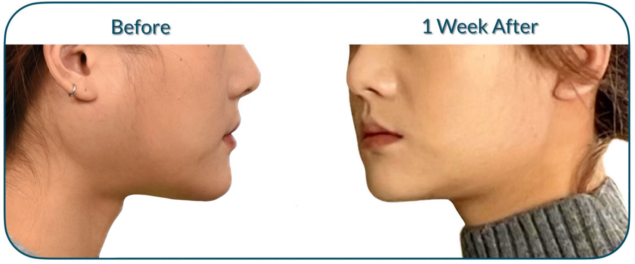 Bilateral Parotidectomy in Beverly Hills, CA | Center for Advanced ...