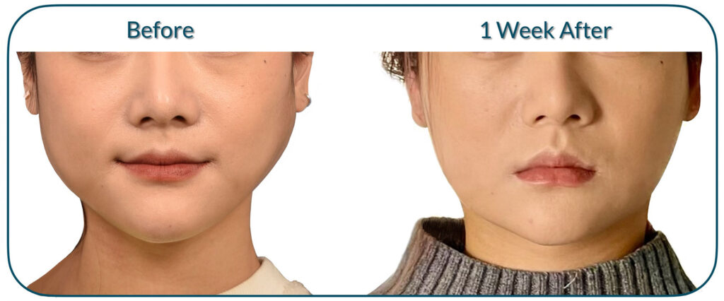 Bilateral Parotidectomy in Beverly Hills, CA | Center for Advanced ...