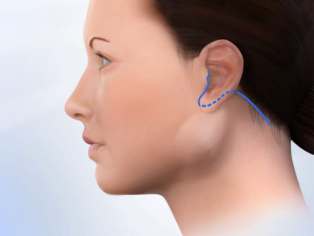 Micro-Parotidectomy in Beverly Hills, CA | Center for Advanced Parotid ...