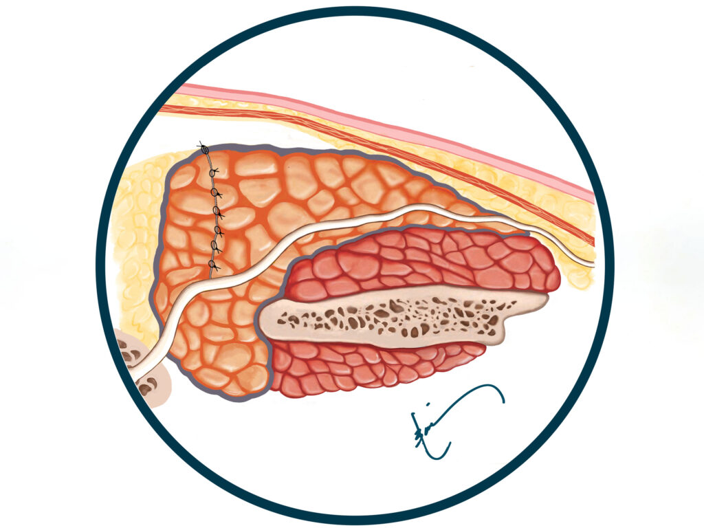 Micro-Parotidectomy - Center for Advanced Parotid Surgery