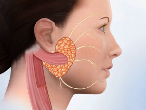Pleomorphic Adenoma in Beverly Hills, CA | Center for Advanced Parotid ...