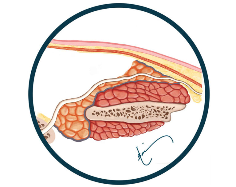 Pleomorphic Adenoma in Beverly Hills, CA | Center for Advanced Parotid ...