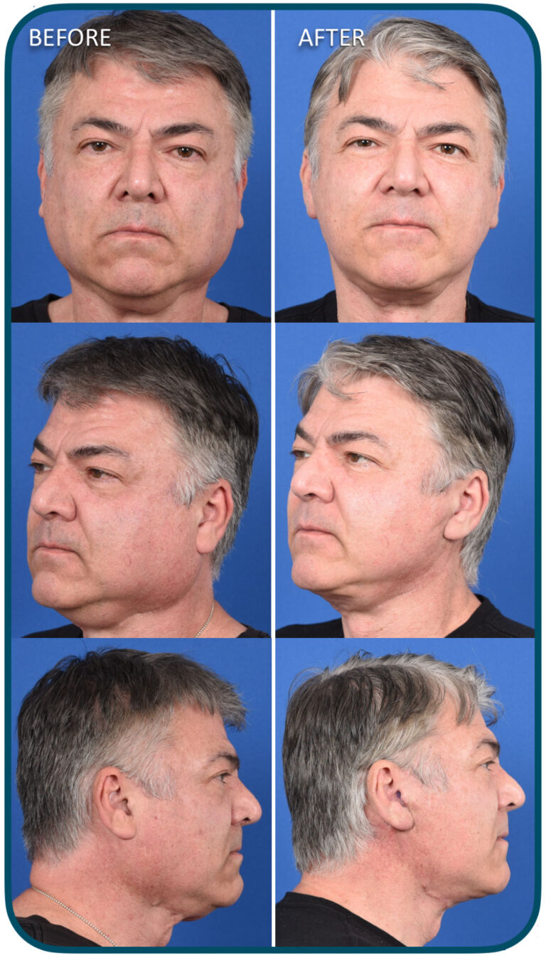 Bilateral Parotidectomy in Beverly Hills, CA | Center for Advanced ...