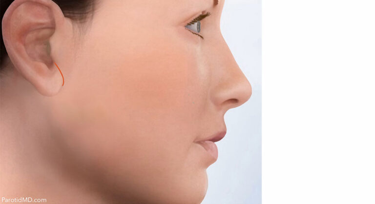 Deep Lobe Tumors in Beverly Hills, CA | Center for Advanced Parotid Surgery