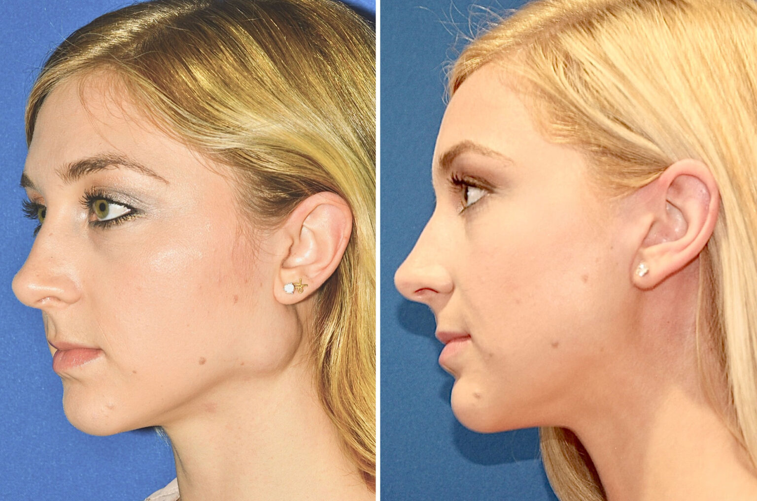 Micro-Parotidectomy in Beverly Hills, CA | Center for Advanced Parotid ...
