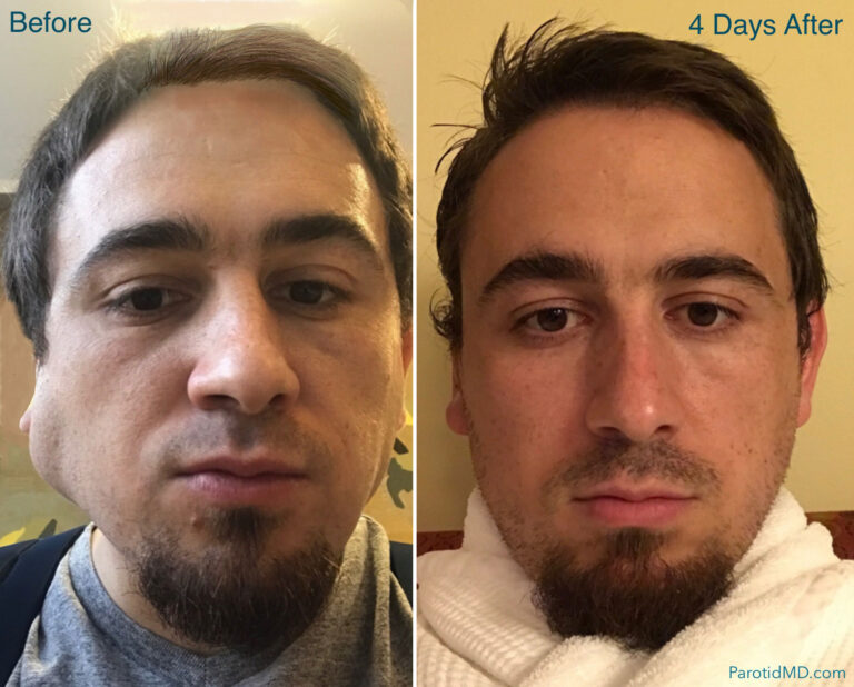 Micro-Parotidectomy - Center for Advanced Parotid Surgery