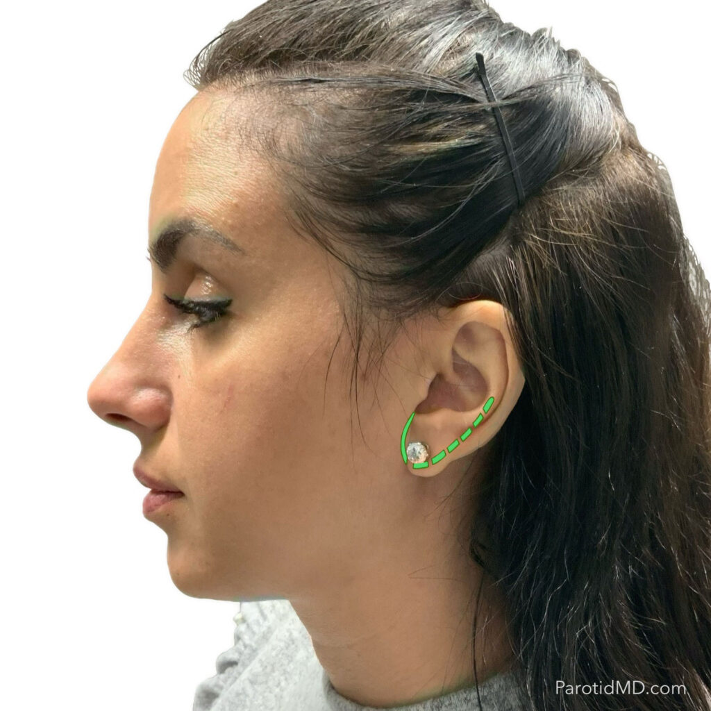 Pleomorphic Adenoma in Beverly Hills, CA | Center for Advanced Parotid ...