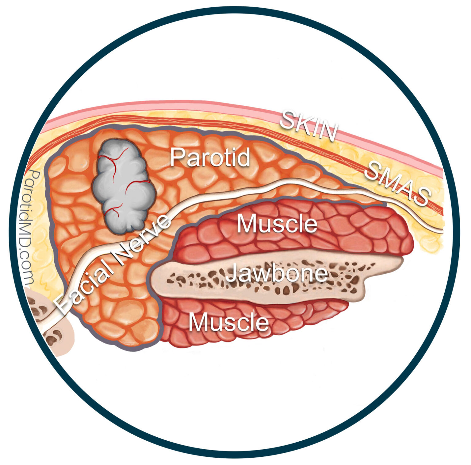 Pleomorphic Adenoma in Beverly Hills, CA | Center for Advanced Parotid ...