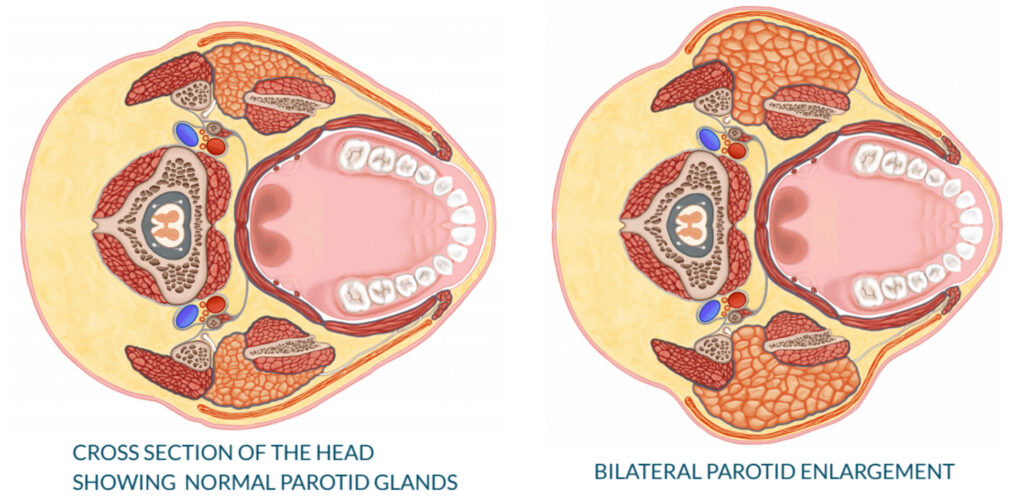 Bilateral Parotidectomy in Beverly Hills, CA | Center for Advanced ...