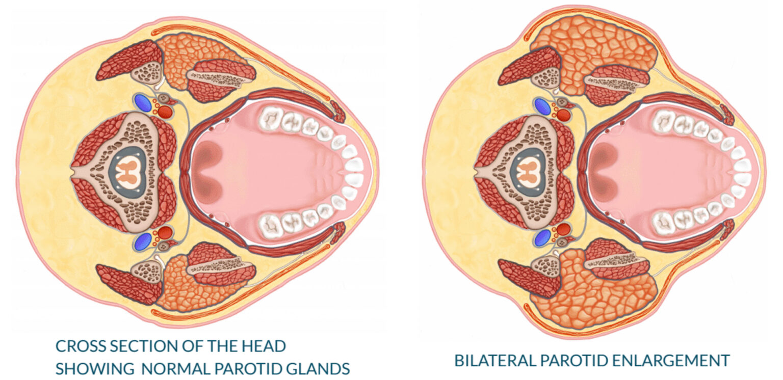 Bilateral Parotidectomy in Beverly Hills, CA | Center for Advanced ...