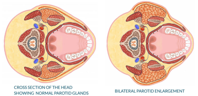 Bilateral Parotidectomy in Beverly Hills, CA | Center for Advanced ...
