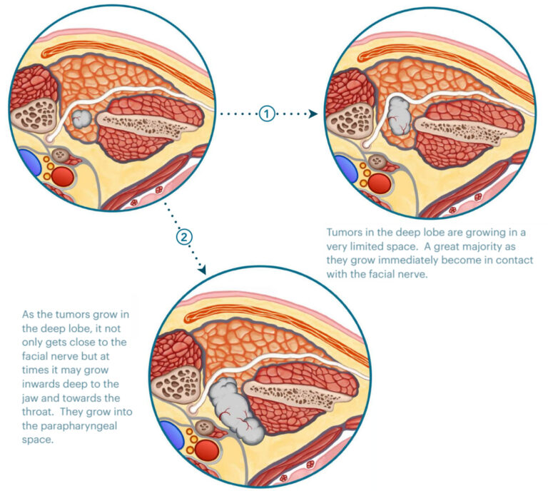 Deep Lobe Tumors in Beverly Hills, CA | Center for Advanced Parotid Surgery
