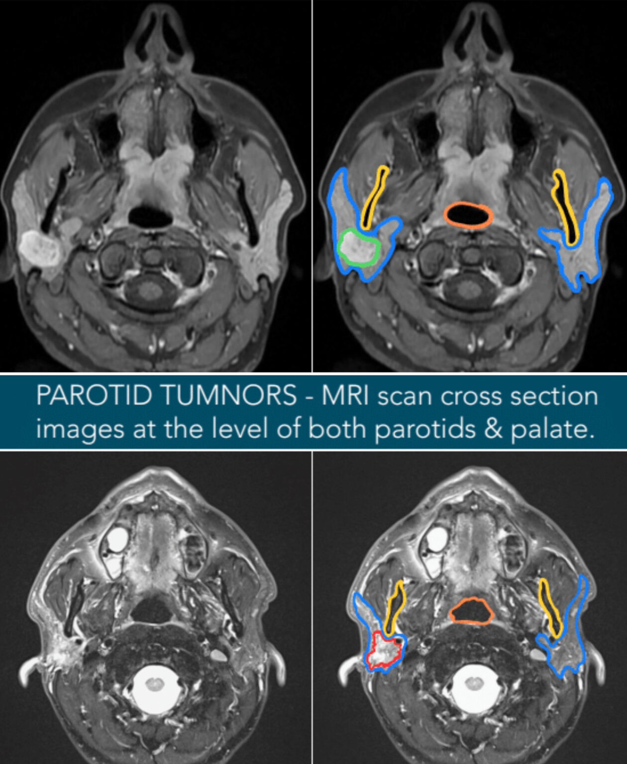 Diagnosis | Center for Advanced Parotid Surgery in Beverly Hills, CA