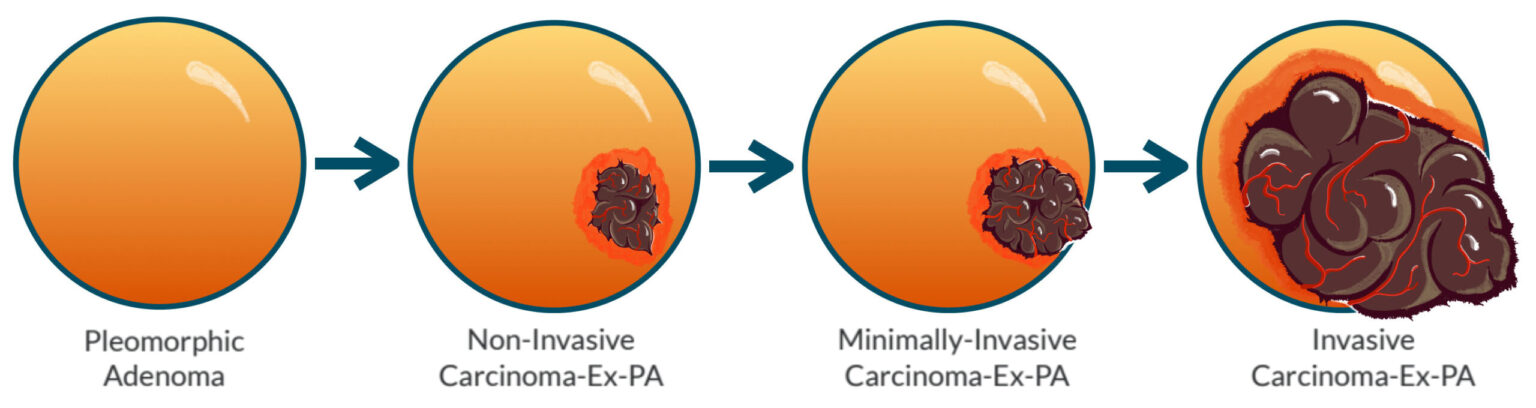 Pleomorphic Adenoma in Beverly Hills, CA | Center for Advanced Parotid ...