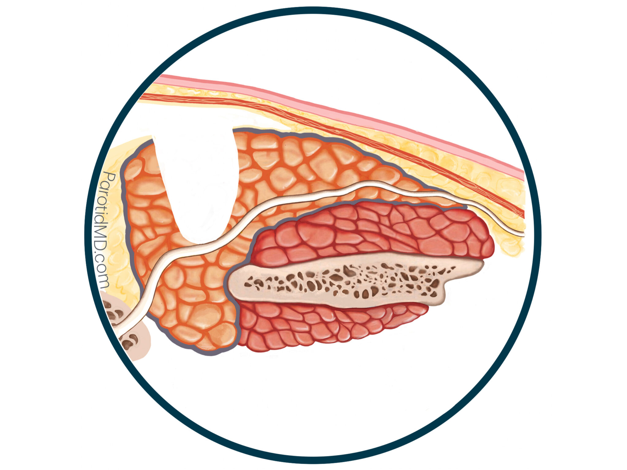 Pleomorphic Adenoma in Beverly Hills, CA | Center for Advanced Parotid ...