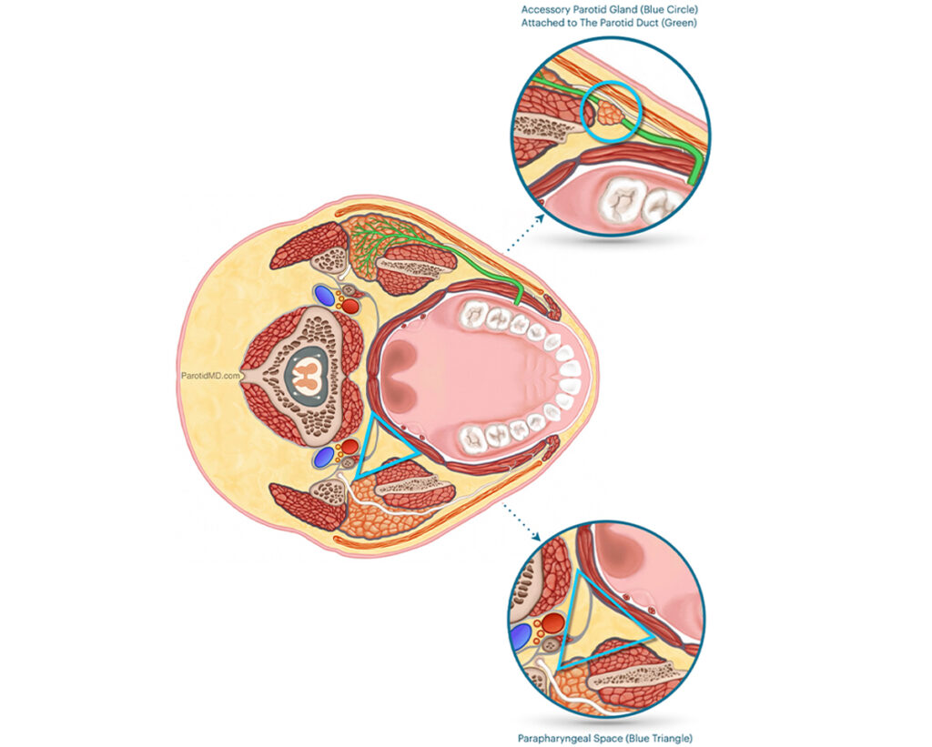Trans-Oral Parotidectomy in Beverly Hills, CA | Center for Advanced ...