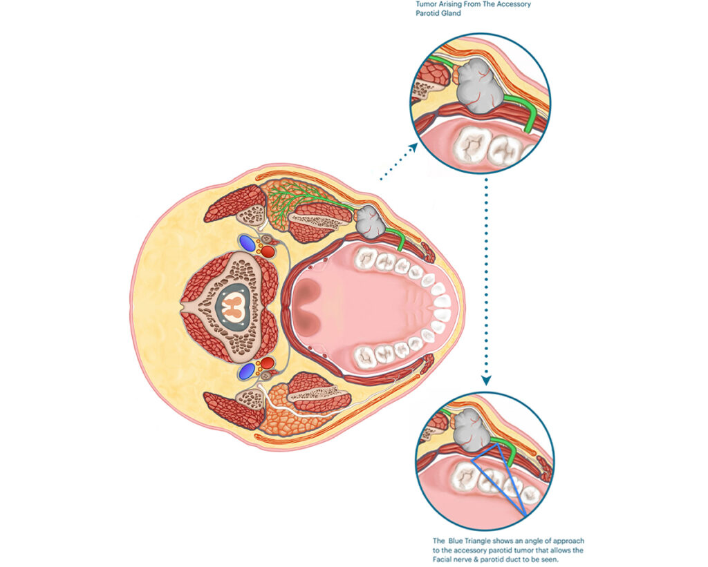 Trans-Oral Parotidectomy in Beverly Hills, CA | Center for Advanced ...