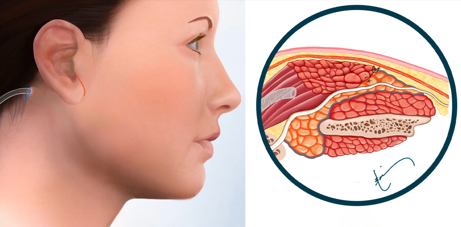 Parotid Reconstruction in Beverly Hills, CA | Center for Advanced ...