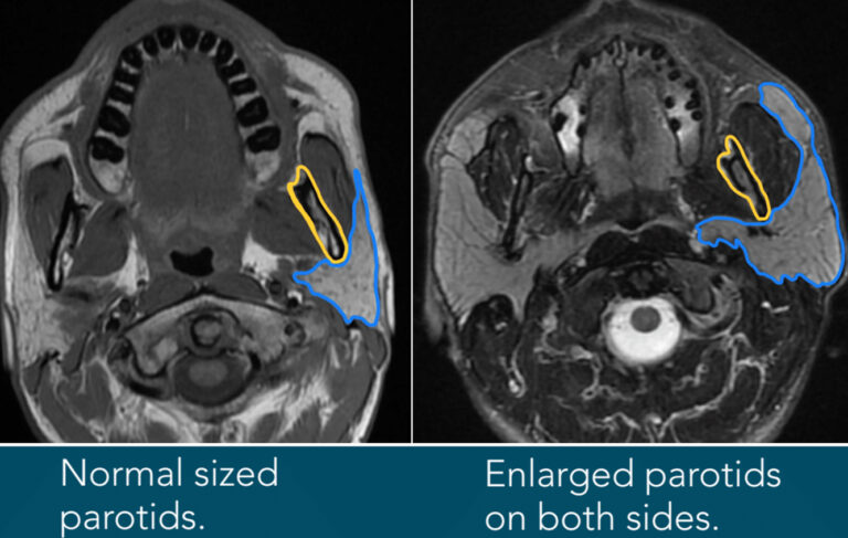 Diagnosis | Center for Advanced Parotid Surgery in Beverly Hills, CA
