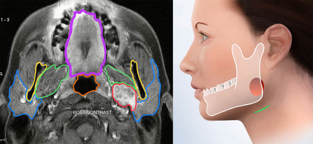 Parotid Cancer | Center for Advanced Parotid Surgery Beverly Hills, CA