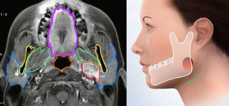 Parotid Cancer | Center for Advanced Parotid Surgery Beverly Hills, CA