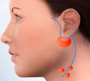 Parotid Cancer | Center for Advanced Parotid Surgery Beverly Hills, CA
