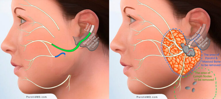 Parotid Cancer | Center for Advanced Parotid Surgery Beverly Hills, CA