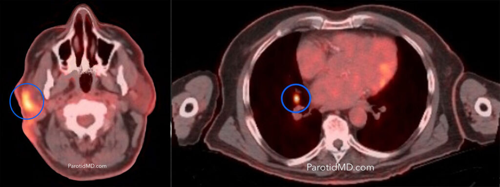 Parotid Cancer | Center for Advanced Parotid Surgery Beverly Hills, CA