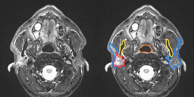 Parotid Cancer | Center for Advanced Parotid Surgery Beverly Hills, CA