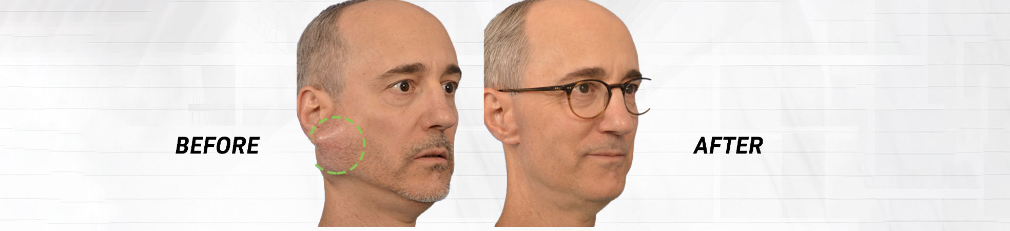 Parotidectomy Los Angeles | Parotid Surgery Los Angeles