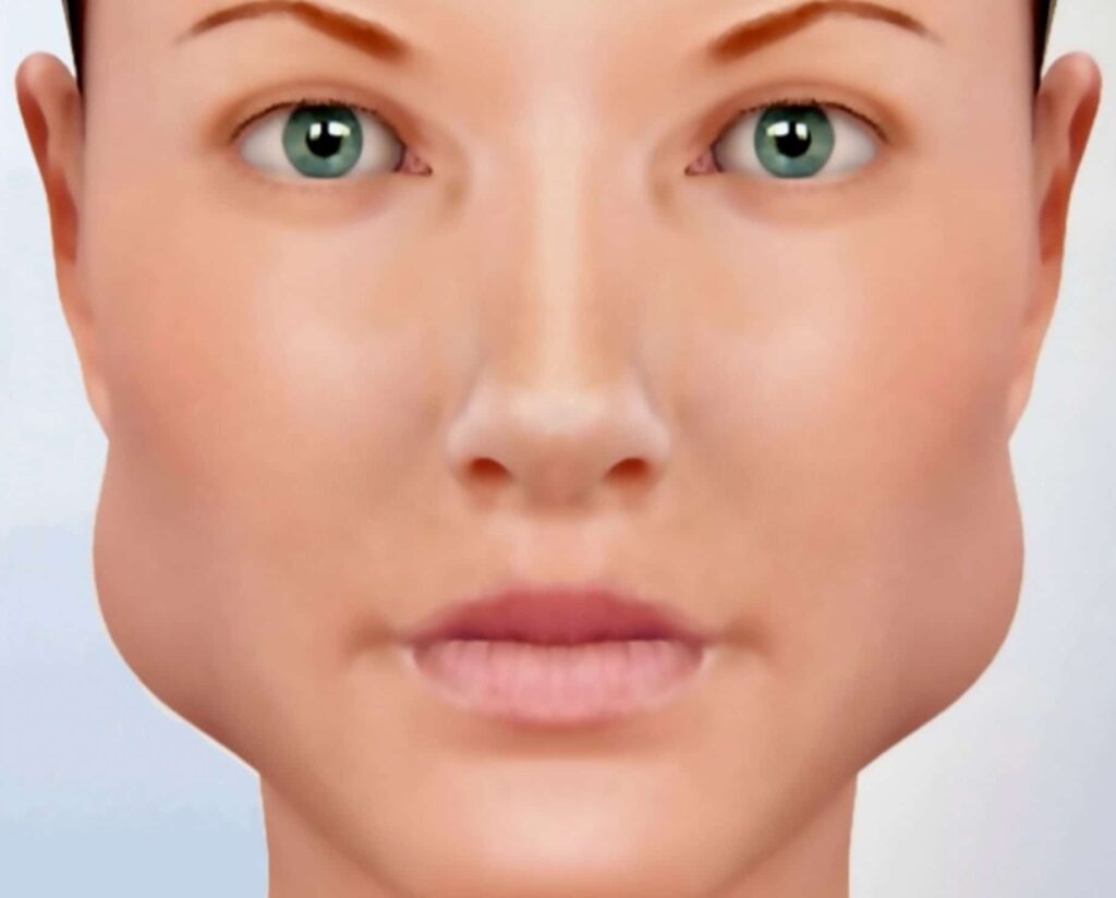 Bilateral Parotid Gland Enlargement: Causes, Symptoms, and When to See ...